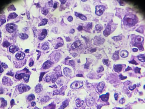 Macrobiopsie et Microbiopsie : Ce qu'il faut savoir